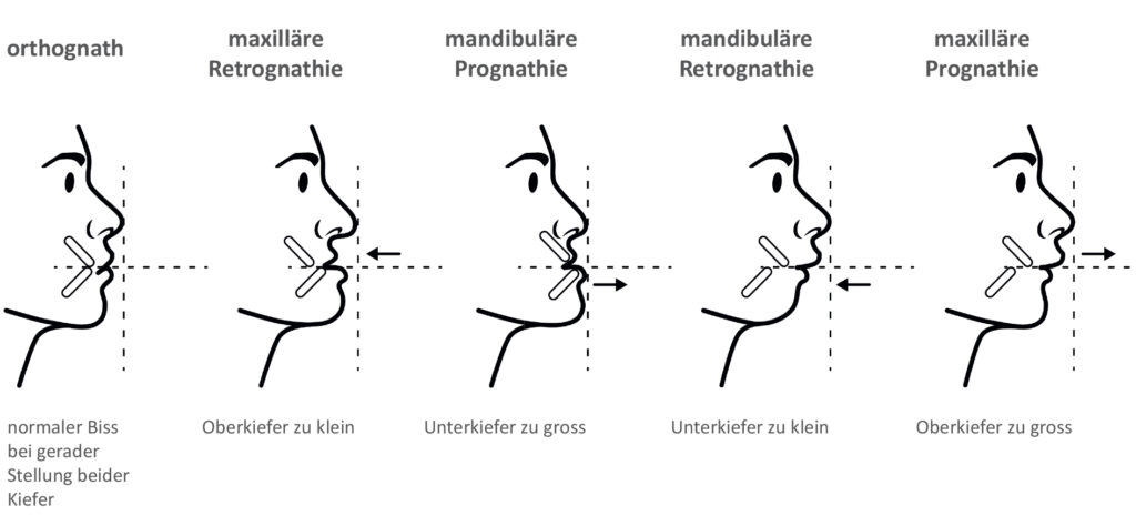 Operation - LKG-Kieferoperation