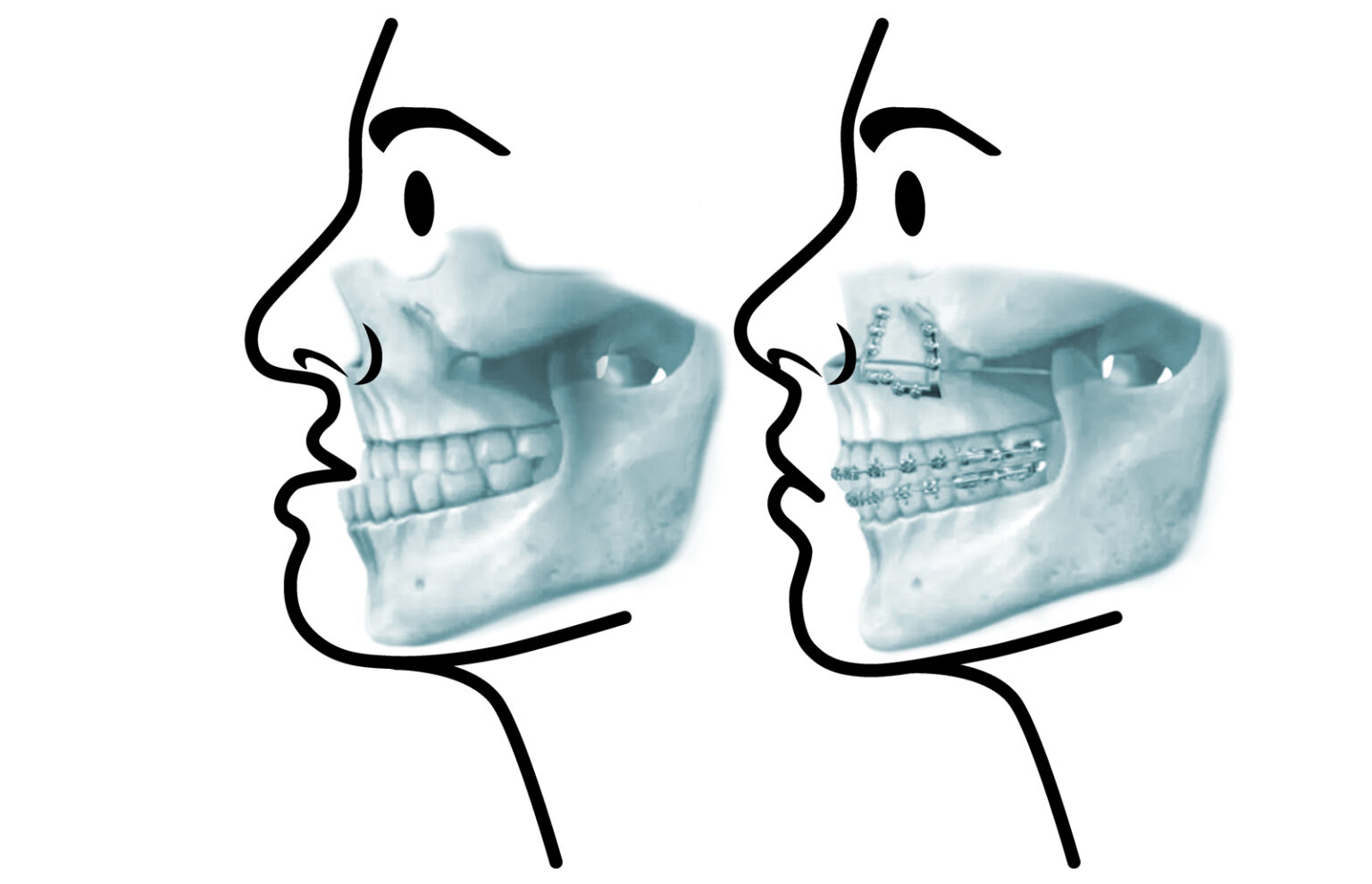 Operation - LKG-Kieferoperation
