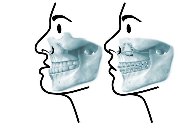 Operation - LKG-Kieferoperation