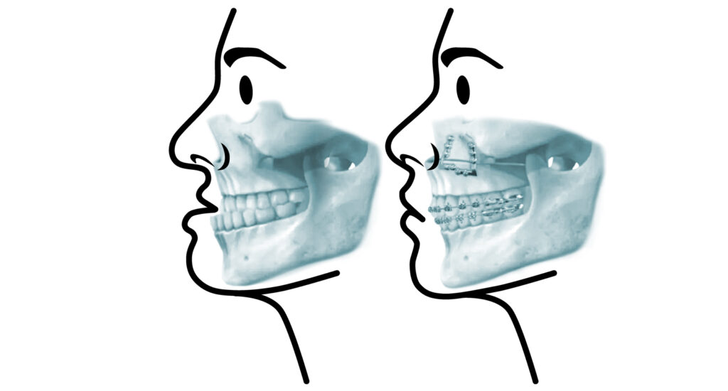 Operation - LKG-Kieferoperation